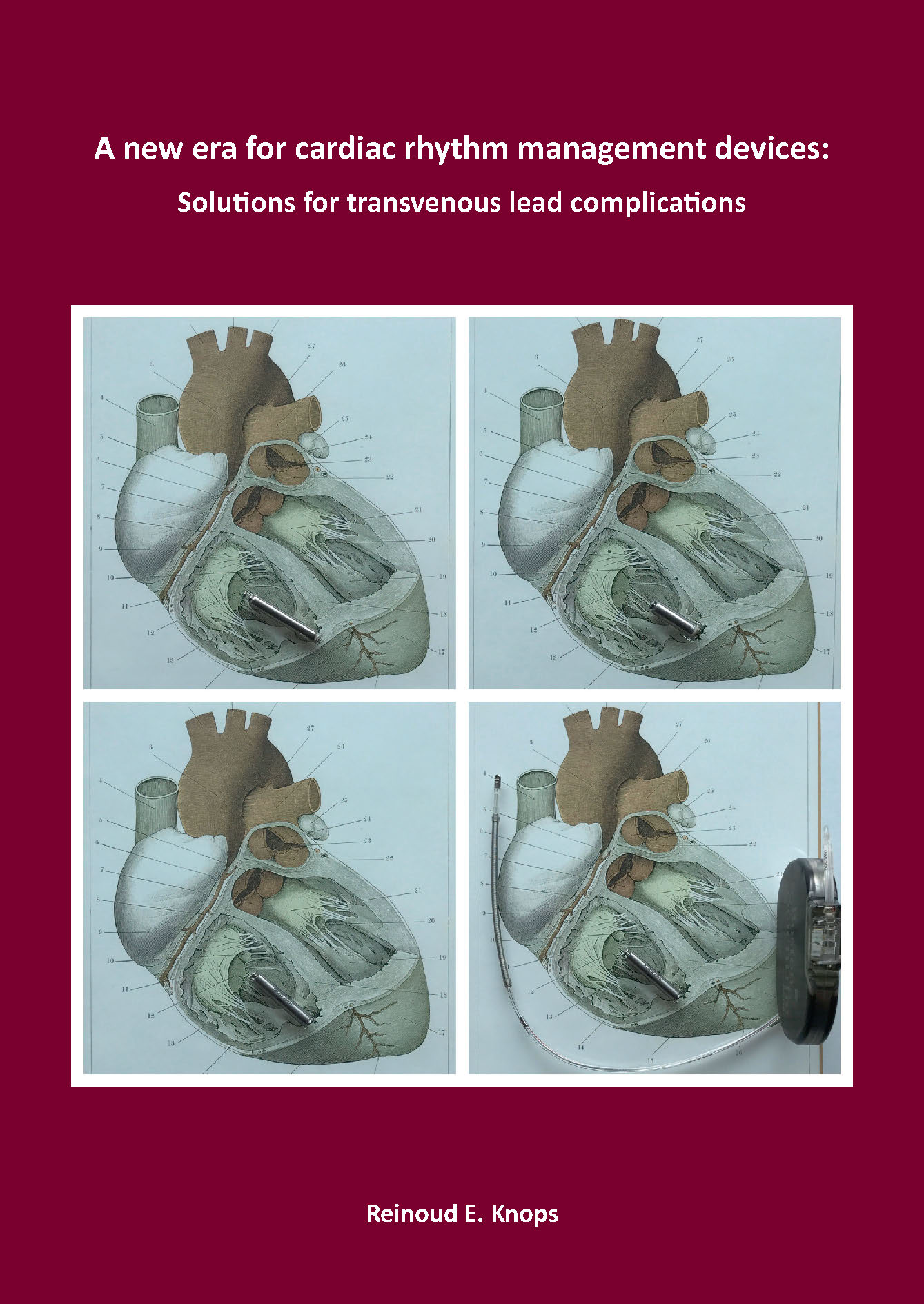 A new era for cardiac rhythm management devices: Solutions for transvenous lead complications ...